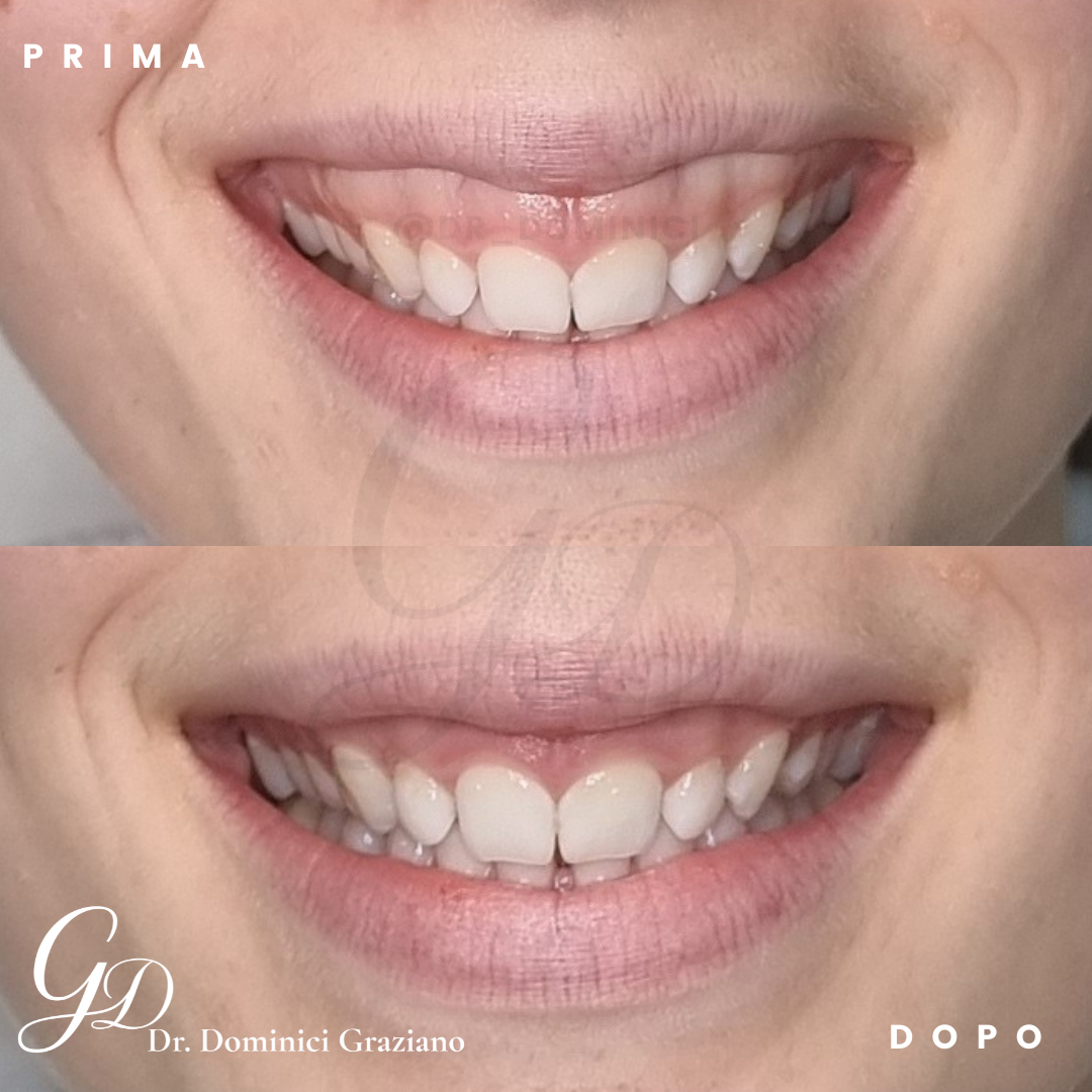 PARLIAMO DI BOTOX - Dr. Graziano Dominici