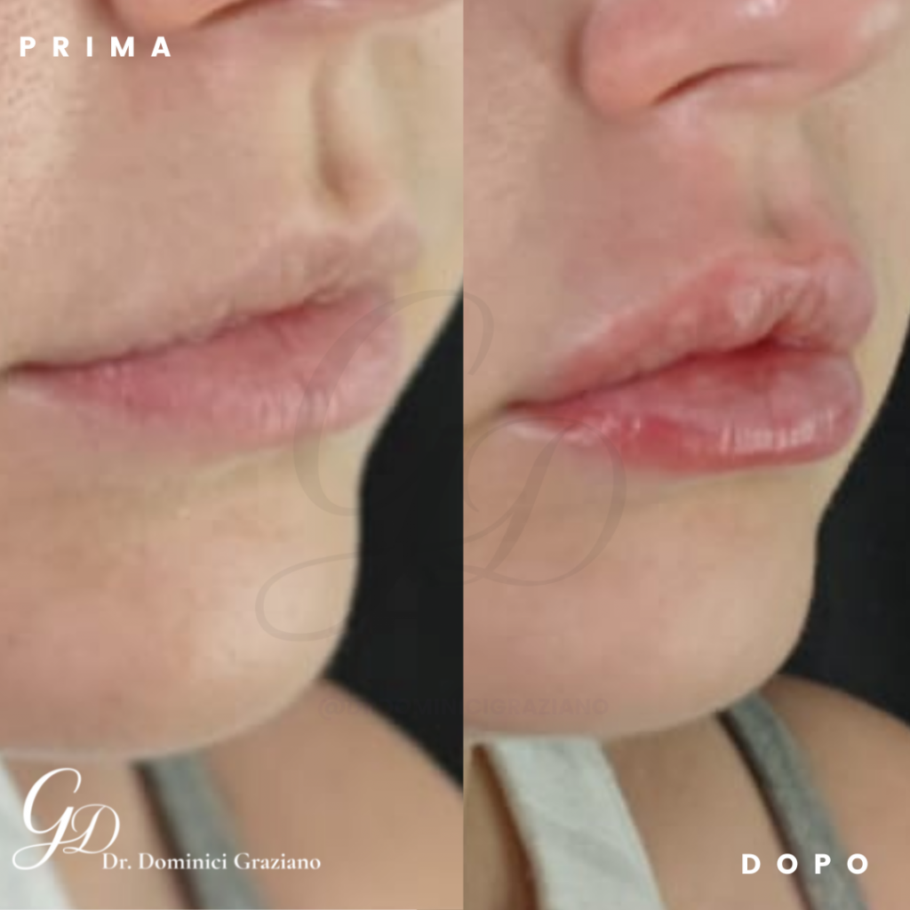 Il lip filler, o filler alle labbra - Dr. Graziano Dominici